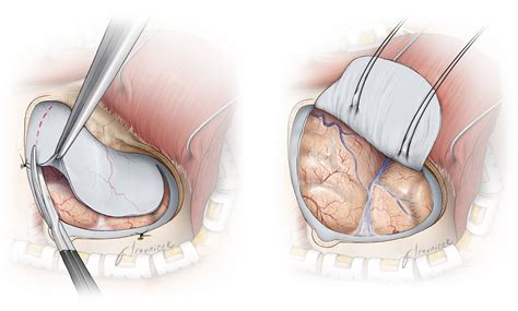 Craniotomy Expert Surgeon Aaron Cohen Gadol Md