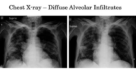 Chest X Ray Shows Diffuse Bilateral Alveolar Infiltrates Download Scientific Diagram