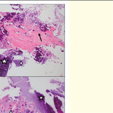 Pdf Caseous Mitral Annular Calcification Along The Anterolateral