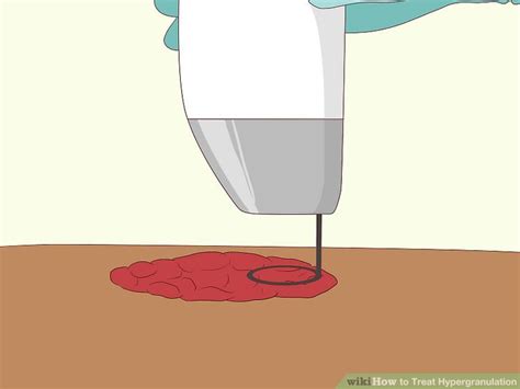 8 Ways To Treat Hypergranulation Wikihow Health