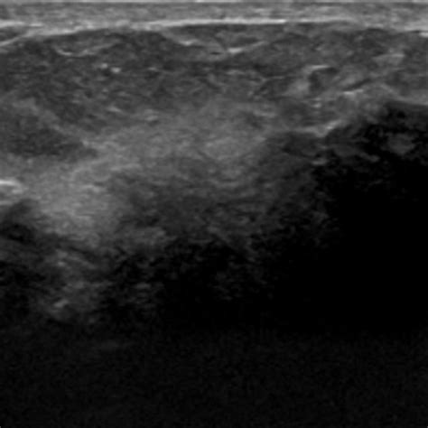 Breast Ultrasound Demonstrating An Irregular Hypoechoic Ill Defined Download Scientific Diagram