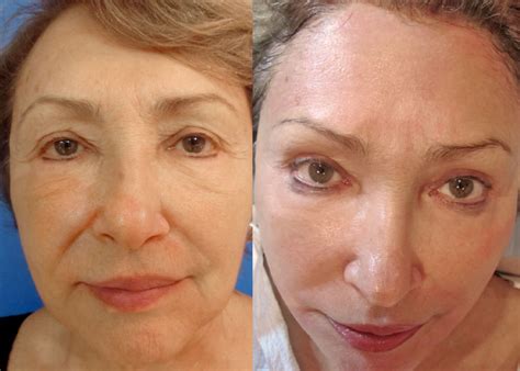 Prp Bio Facelift In Miami Florida