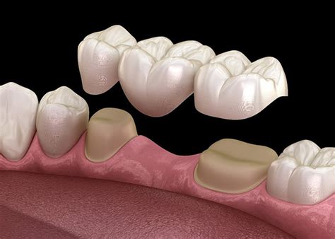 Dental Bridge Cost What You Need To Consider