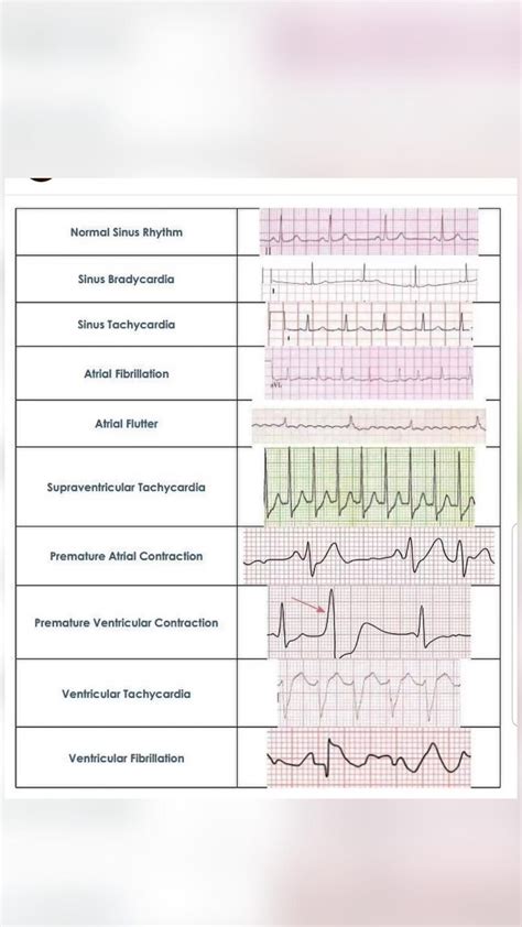 Ekg Explanation Nursing School Notes Artofit