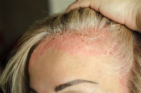 Fda Accepts Snda Of Roflumilast Foam For Scalp And Body Psoriasis