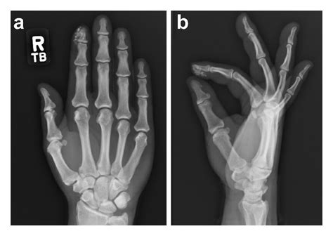 Figure 1 From Considerations For Hand Surgery In Patients With Scleroderma Semantic Scholar