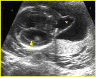 Skull Defects Department Of Obstetrics And Gynecology Faculty Of