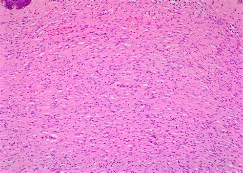 Neurofibroma Histology