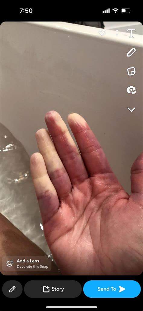 Reynauds And Botox Rscleroderma