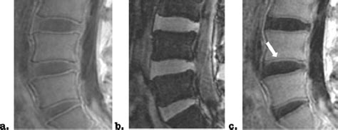 Figure 1 From Ultra Short Echo Time Mr Imaging In Assessing Cartilage