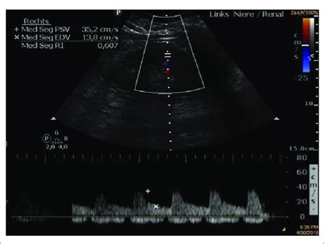 Renal Doppler Ultrasound With Renal Resistive Index Rri Measurement