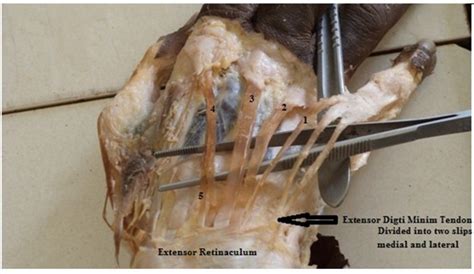 Extensor Digiti Minimi Tendon Variations Case Report
