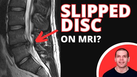 Slipped Disk Operation At Frank Keith Blog