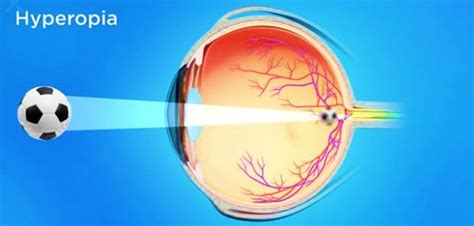 Optics Of Hyperopia Optography