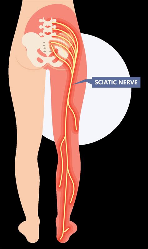 Sciatica How To Treat That Radiating Leg Pain Chiropractic Singapore