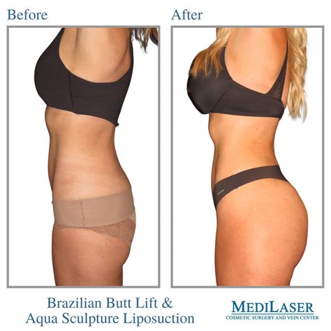 Brazilian Butt Lift Before And After Medilaser Surgery And Vein Center