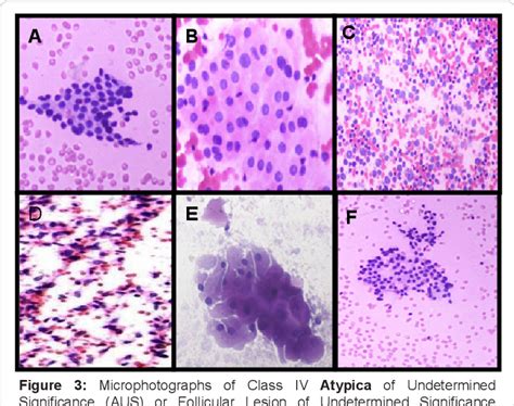 Figure 3 From Better Thyroid Cytopathology Reporting System May Increase The Clinical Management