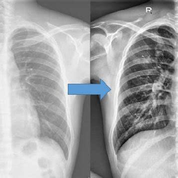 Pdf Pulmonary Tuberculosis Detection Using Deep Learning Convolutional Neural Networks