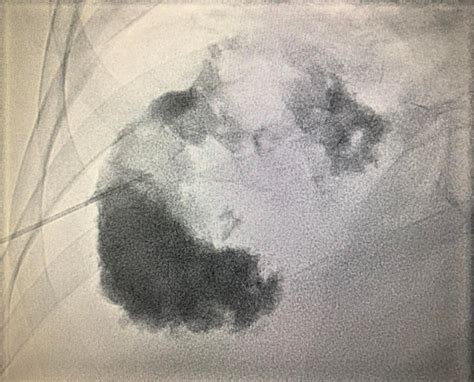 The Filipino Interventional Radiologist