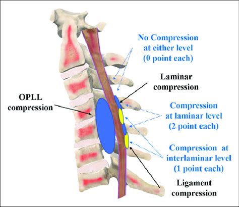Schematic Drawings Of The Posterior Compression Score Of The Spinal Download Scientific Diagram