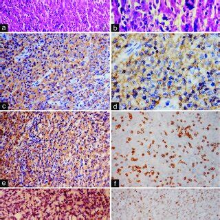 Diffuse Large B Cell Lymphoma A And B Centroblastic Variant Download Scientific Diagram