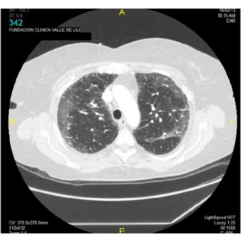 Chest Computed Tomography Showing Diffuse Reticular Interstitial