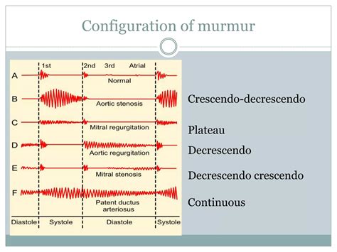 Approach To Heart Murmurspptx