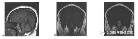 垂体腺瘤的丛征医学界 助力医生临床决策和职业成长 垂体腺瘤的丛征医学界 助力医生临床决策和职业成长