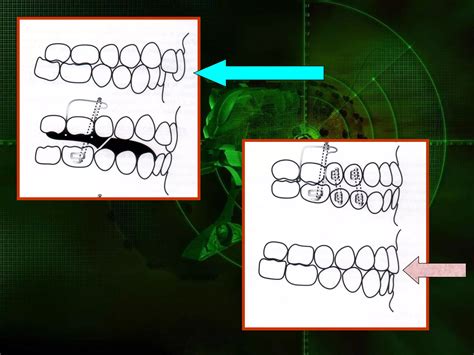 Twin Block Effects Ppt