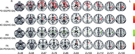 Comparison Of Diffusion Tensor Imaging Indices Fa Rd Between Groups