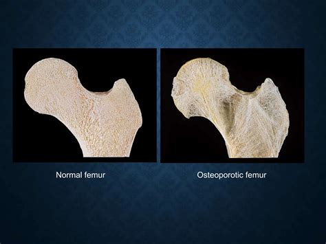atrophy and dystrophy accumulation ppt