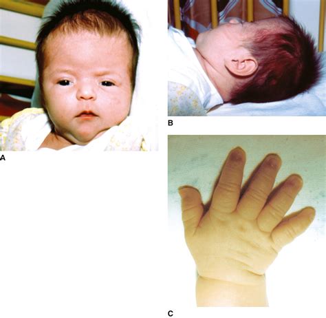 Craniosynostosis Syndromes Clinical Tree