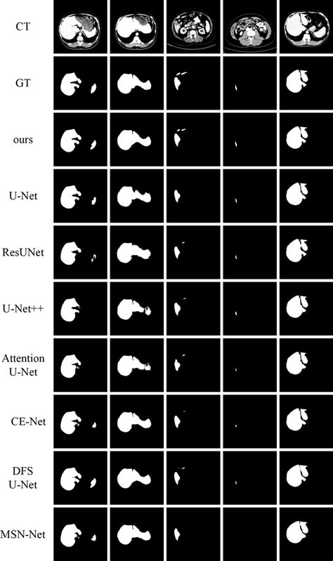 Comparison Of Segmentation Results Of Each Method On 3dircadb Andchaos