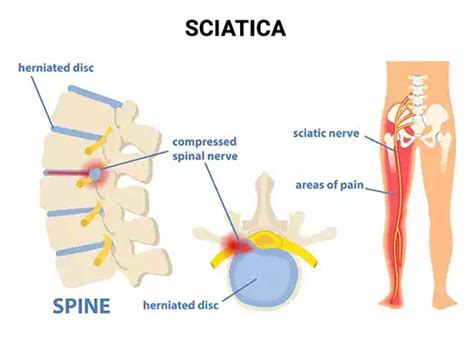 Sciatica Treatment London One Body Ldn