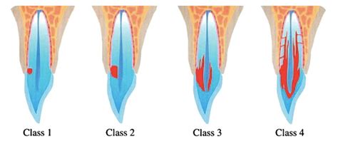 The Root Of The Problem External Cervical Resorption Dentistry Online