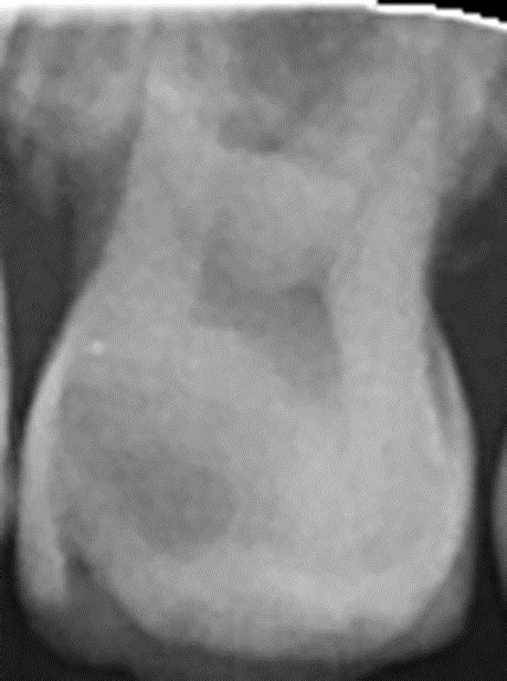 Upper Teeth Instance Segmentation Model By Pulp Ai