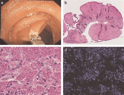 Abnormal Biopsy Endoscopy Distal Esophageal Biopsies From Second