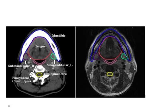 Atlas Of Organs At Risk Delineation Head And Neck Region