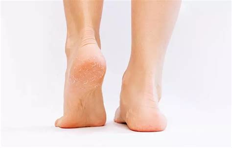Selsun Blue For Skin Benefits For Treating Skin Conditions