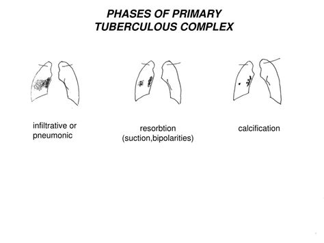 Ppt Primary Tuberculosis Powerpoint Presentation Free Download Id 4070372