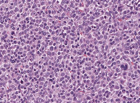 Extramedullary Tumor Dog Dog