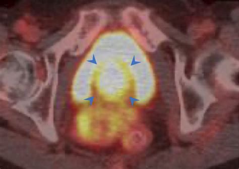 Positron Emission Tomography‐computed Tomography Showed Uptakes In Urethra Download