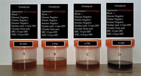 Classical Paroxysmal Nocturnal Hemoglobinuria Presenting With Severe