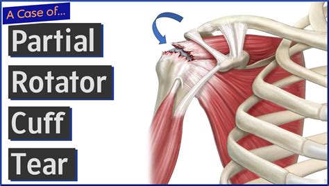Partial Rotator Cuff Tear Meded Cases