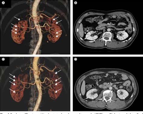 Figure 1 From Renal Infarction After Nsaid Treatment Semantic Scholar