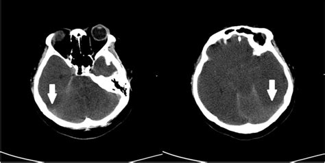 On The Fifth Day Of Admission Ct Of The Head Showed That Diffuse