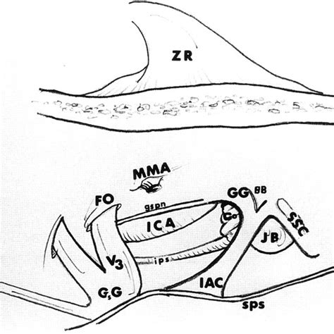 Pdf Surgical Anatomy Of The Extended Middle Cranial Fossa Approach