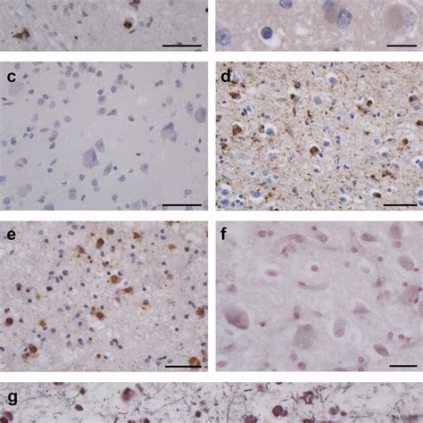 Staining Of The Frontal Cortex From Case 2 With Mapt Mutation ∆k281