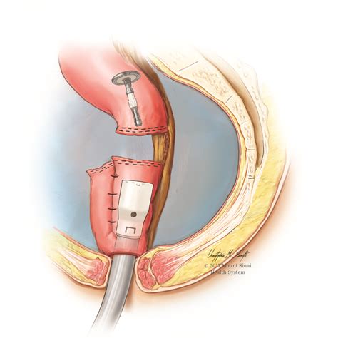 J Pouch Ileoanal Anastomosis