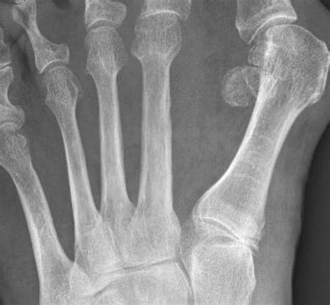 Metatarsus Primus Varus